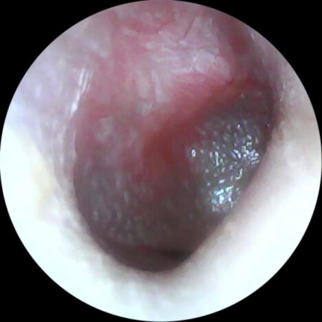 Otite Média Aguda: Sintomas, Causas e Tratamento